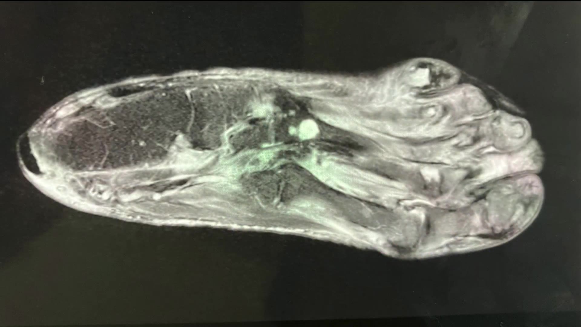 Emergency Toe Amputation PKG – KX NEWS