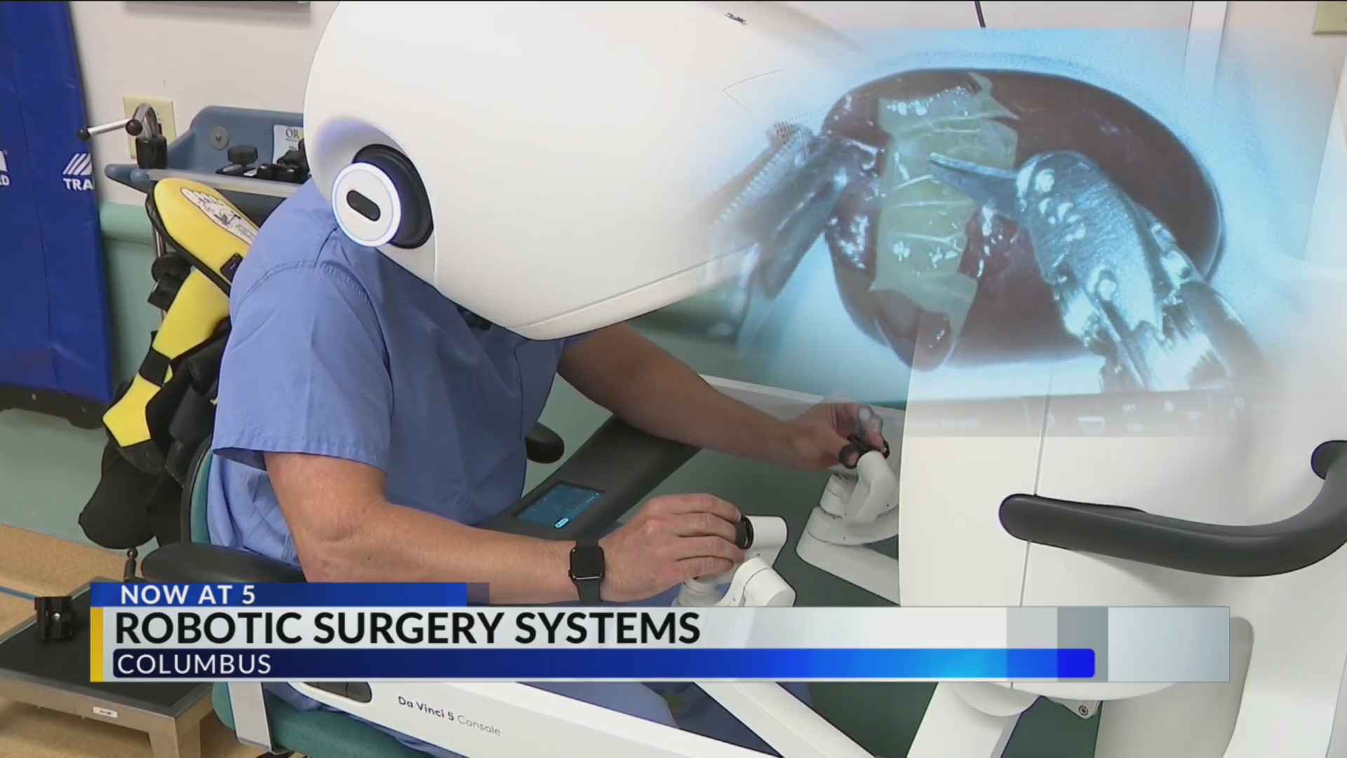 Columbus Regional Health using new robotic surgery machines – Fox 59