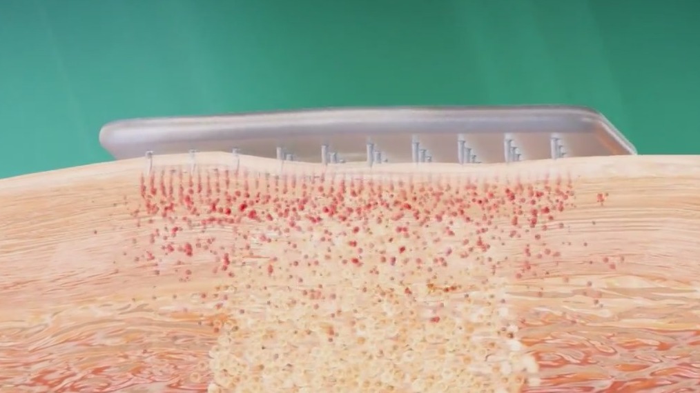 New skin care patch from Medicus Pharma – KOIN.com