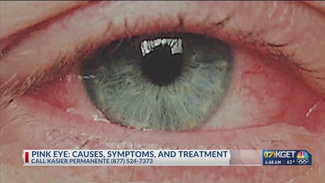 Pink Eye: Causes, symptoms and treatments – KGET 17 News