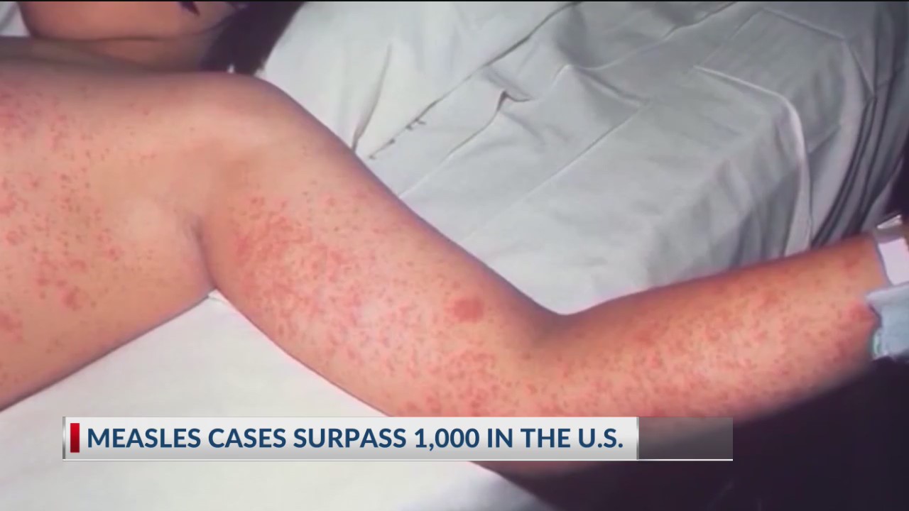 Measles cases surpass 1,000 in the U.S. – KSNT 27 News