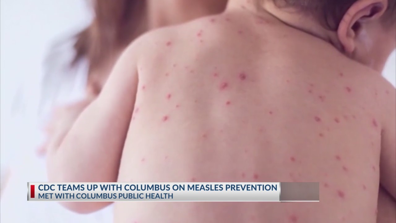 Columbus, CDC team up for measles prevention – NBC4 WCMH-TV