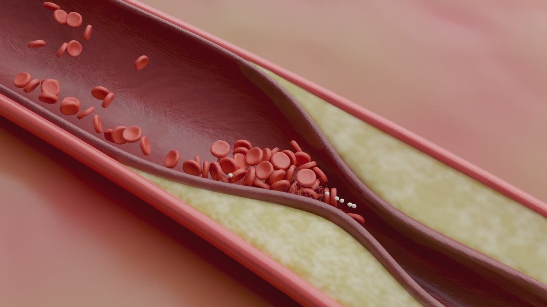 Tackling high cholesterol with Dr. Dharmesh Patel of Stern ...