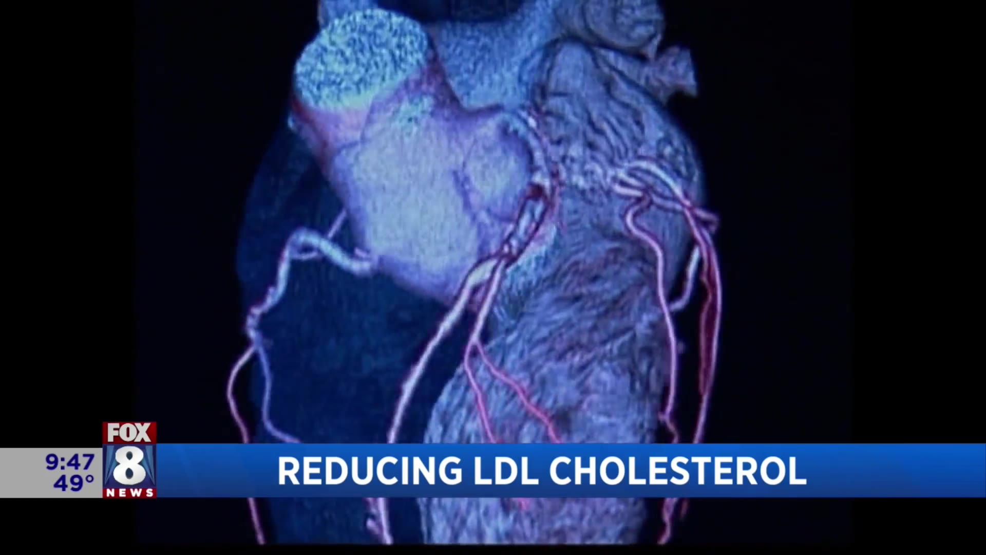 Drug combo may cut your bad cholesterol by nearly half – Fox 8 ...