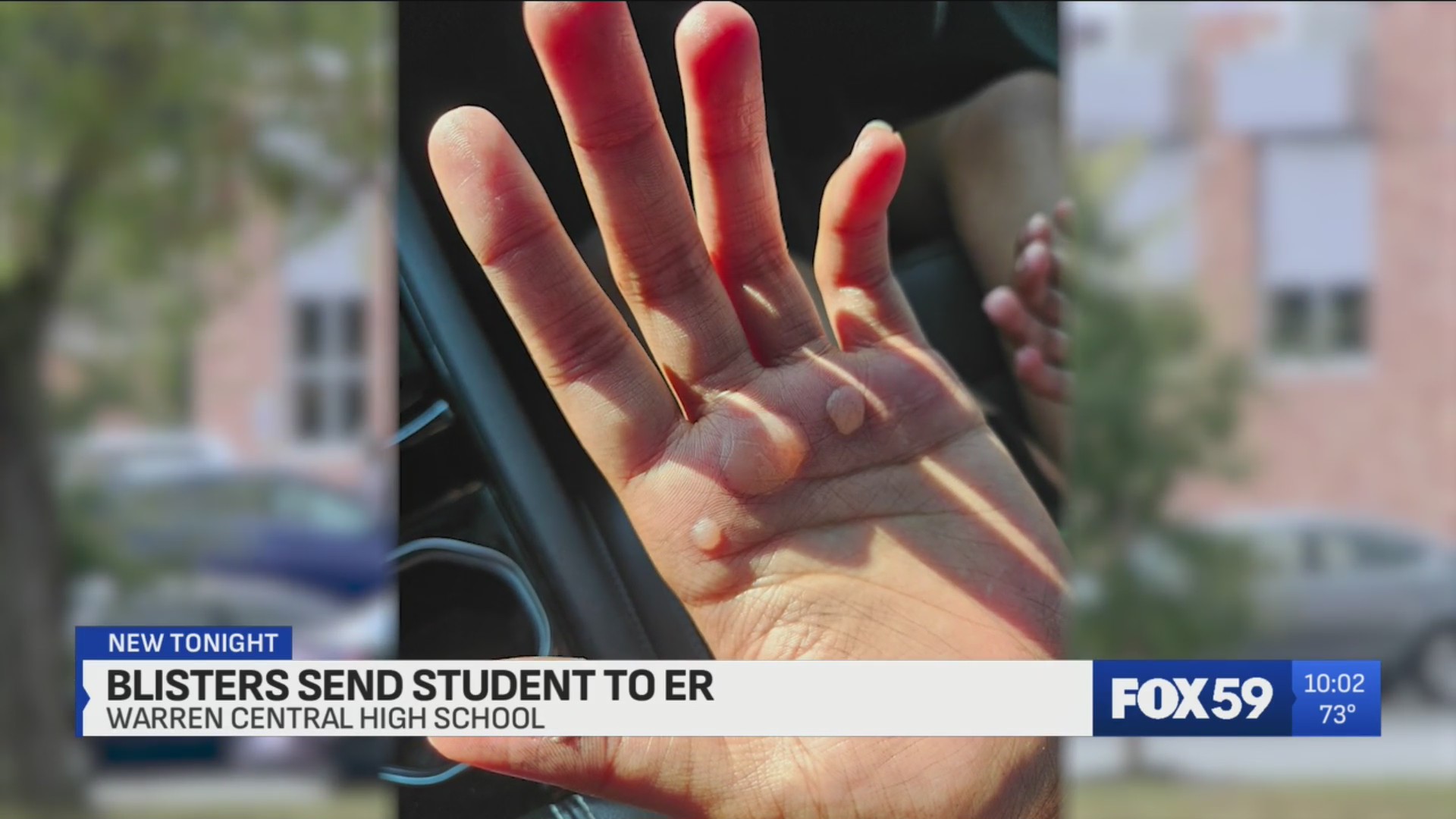 Warren Central student suffers second-degree burns from dance team ...