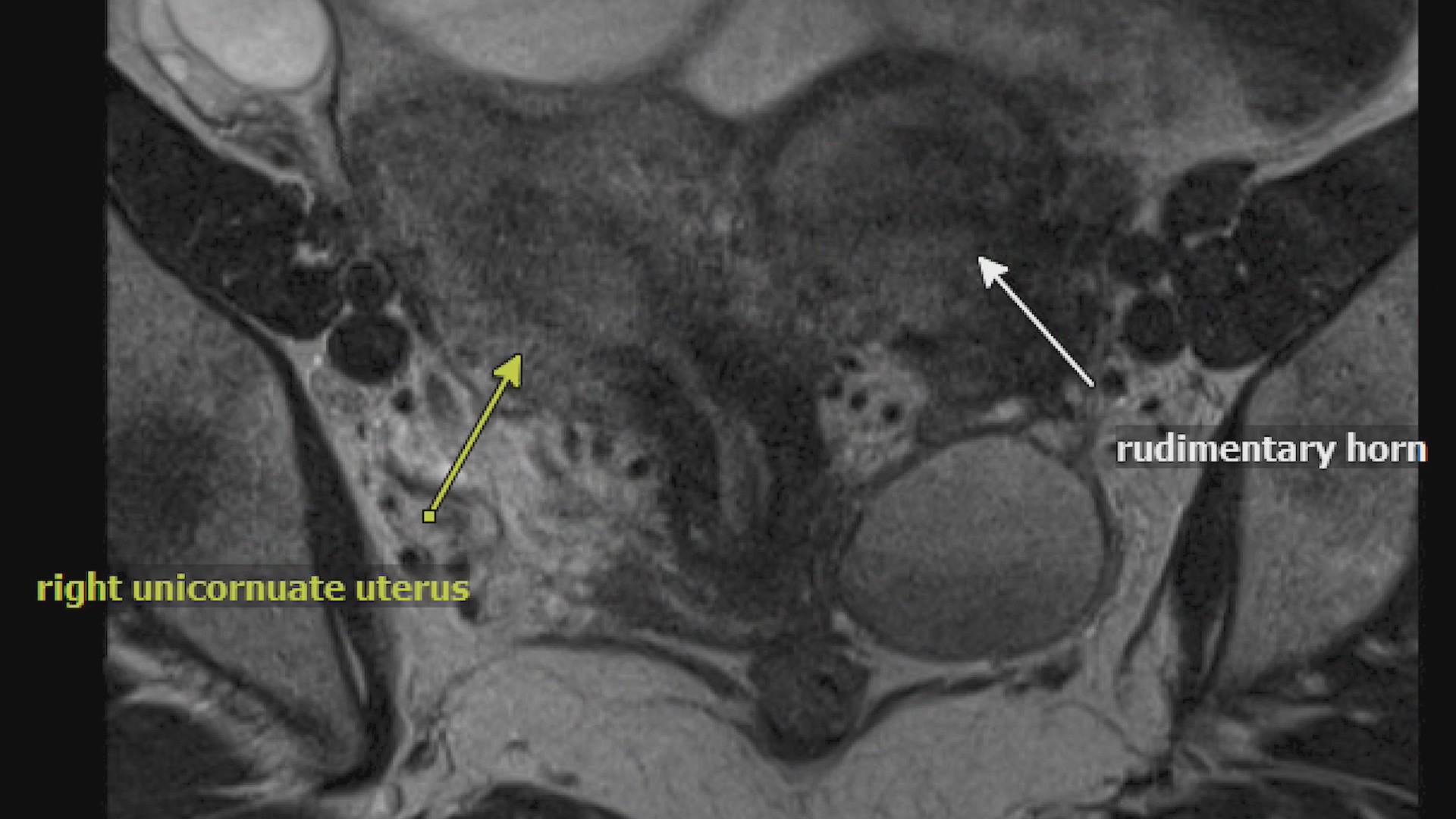 ‘I thought it was normal’: Doctor discovers rare uterus condition in ...