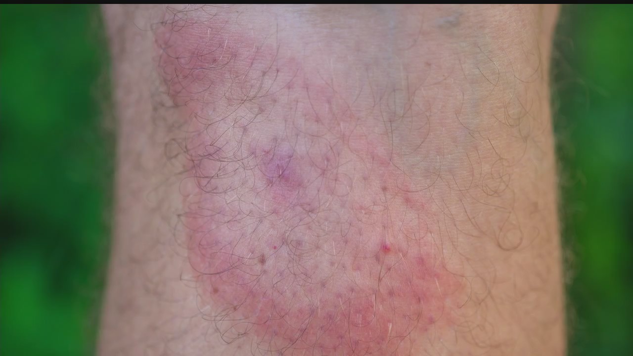 Dr. says tick illness on the rise, how to prevent Lyme Disease – WKBN.com