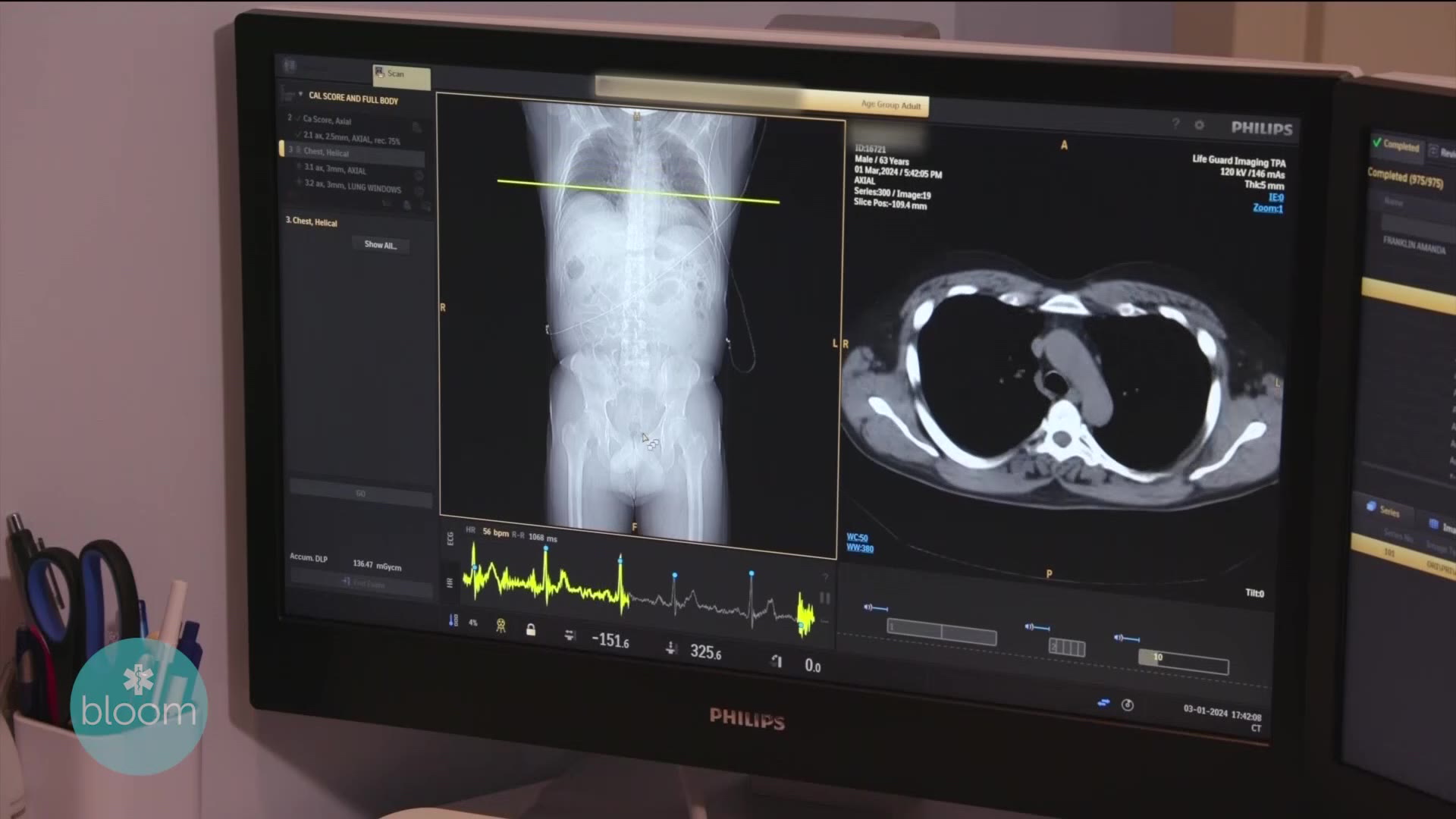 Saving lives through early detection with Life Guard Imaging – WFLA