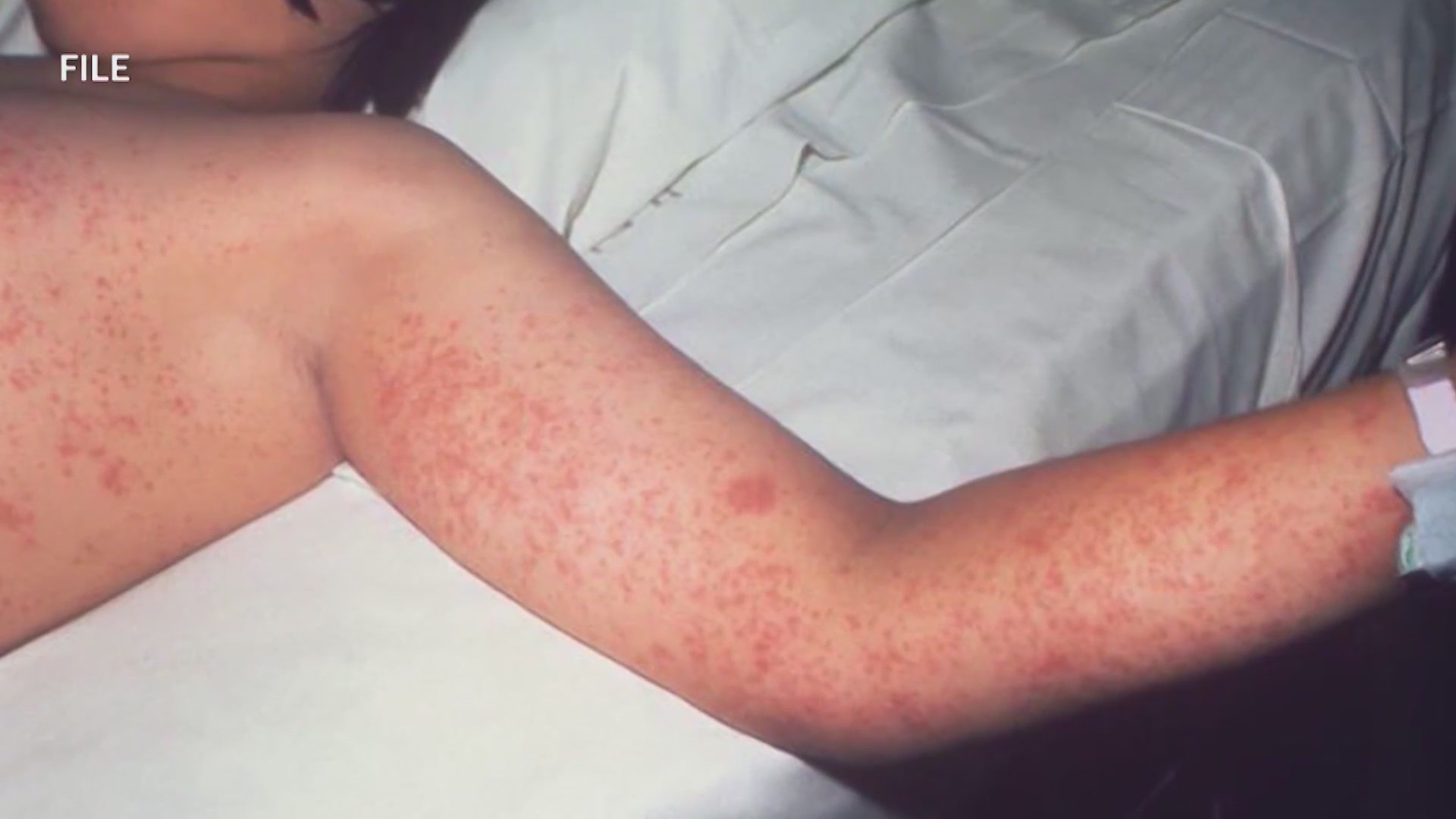 Cook County health officials report first 2 measles cases of 2025, both ...