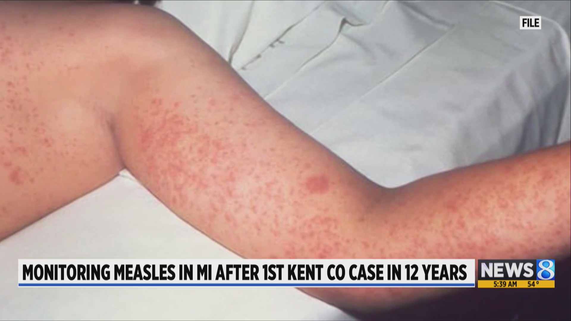 Monitoring measles in Michigan after first Kent County case in 12 years ...