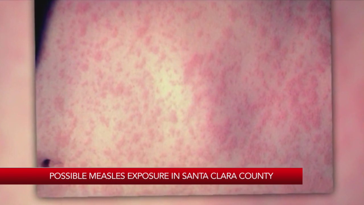 Possible measles exposure in Santa Clara County – KRON4