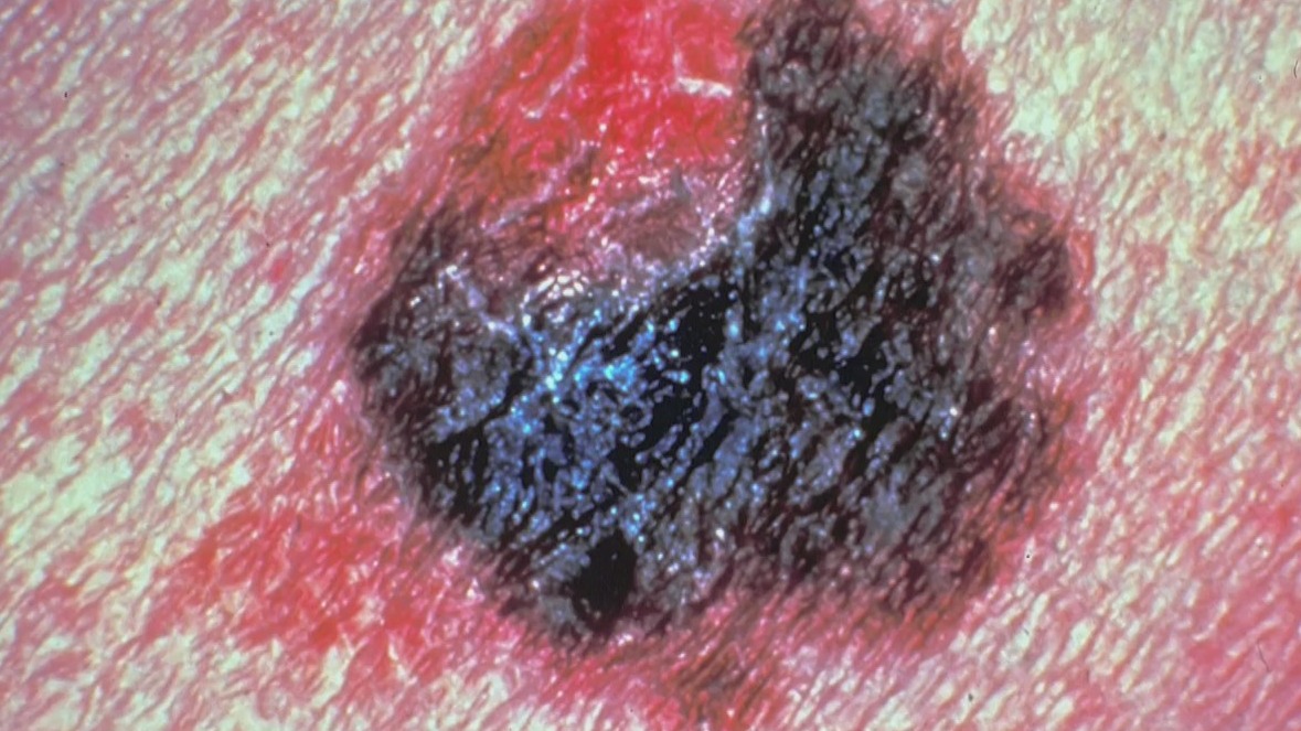 Dermatologist shares tips to protect against skin cancer | NewsNation ...