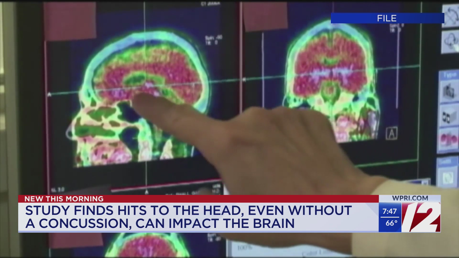 BU researcher: Brain damage can show up years before signs of CTE ...