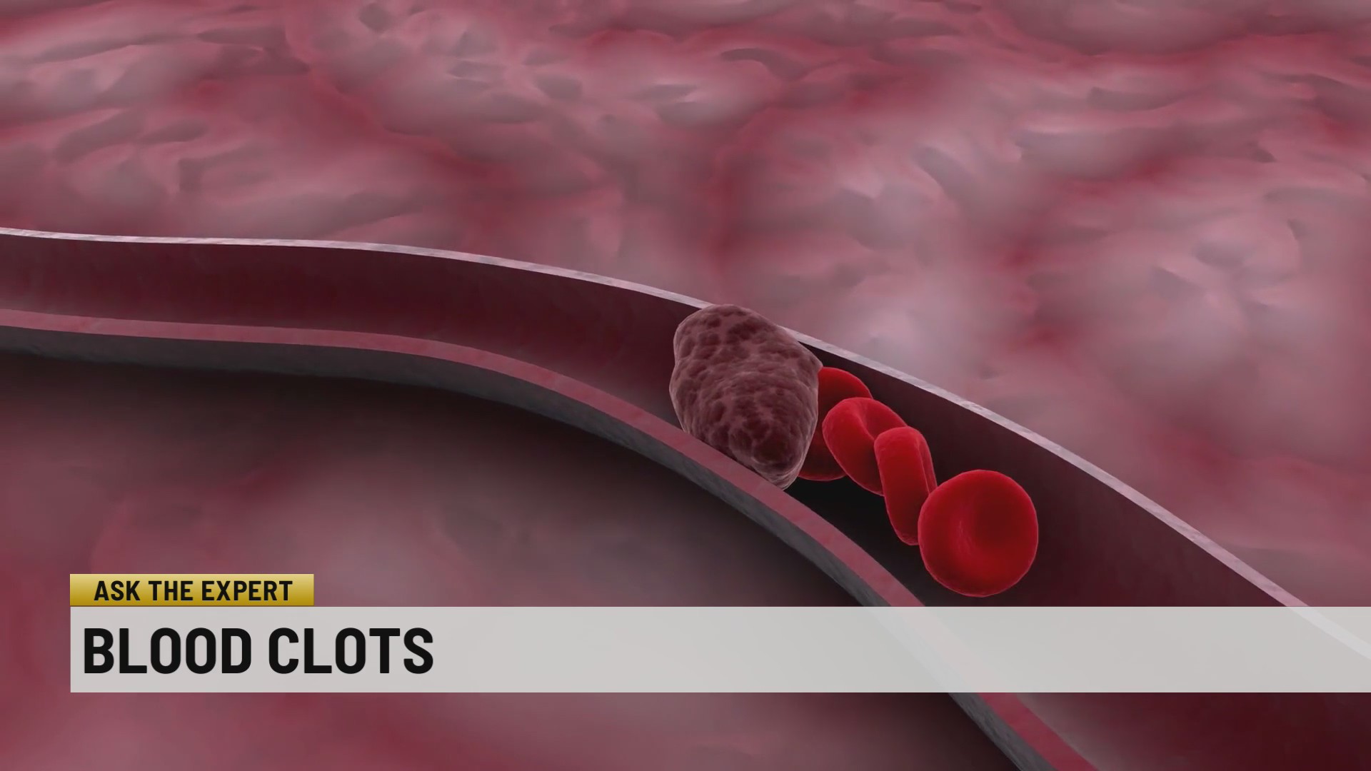 Ask the Expert: The Warning Signs of Blood Clots – WSPA 7NEWS