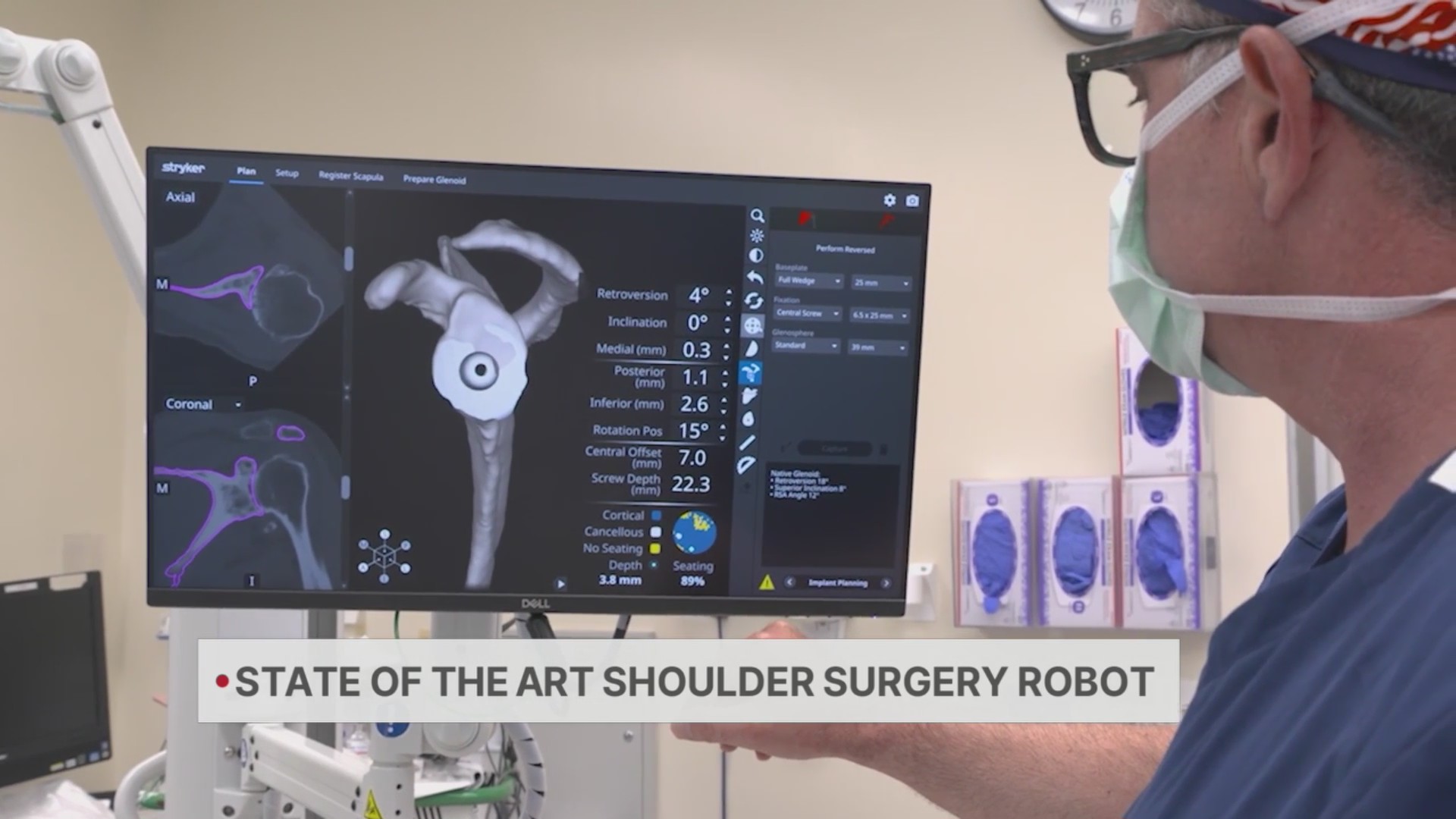 State of the art robot shoulder surgery is a success – KRON4