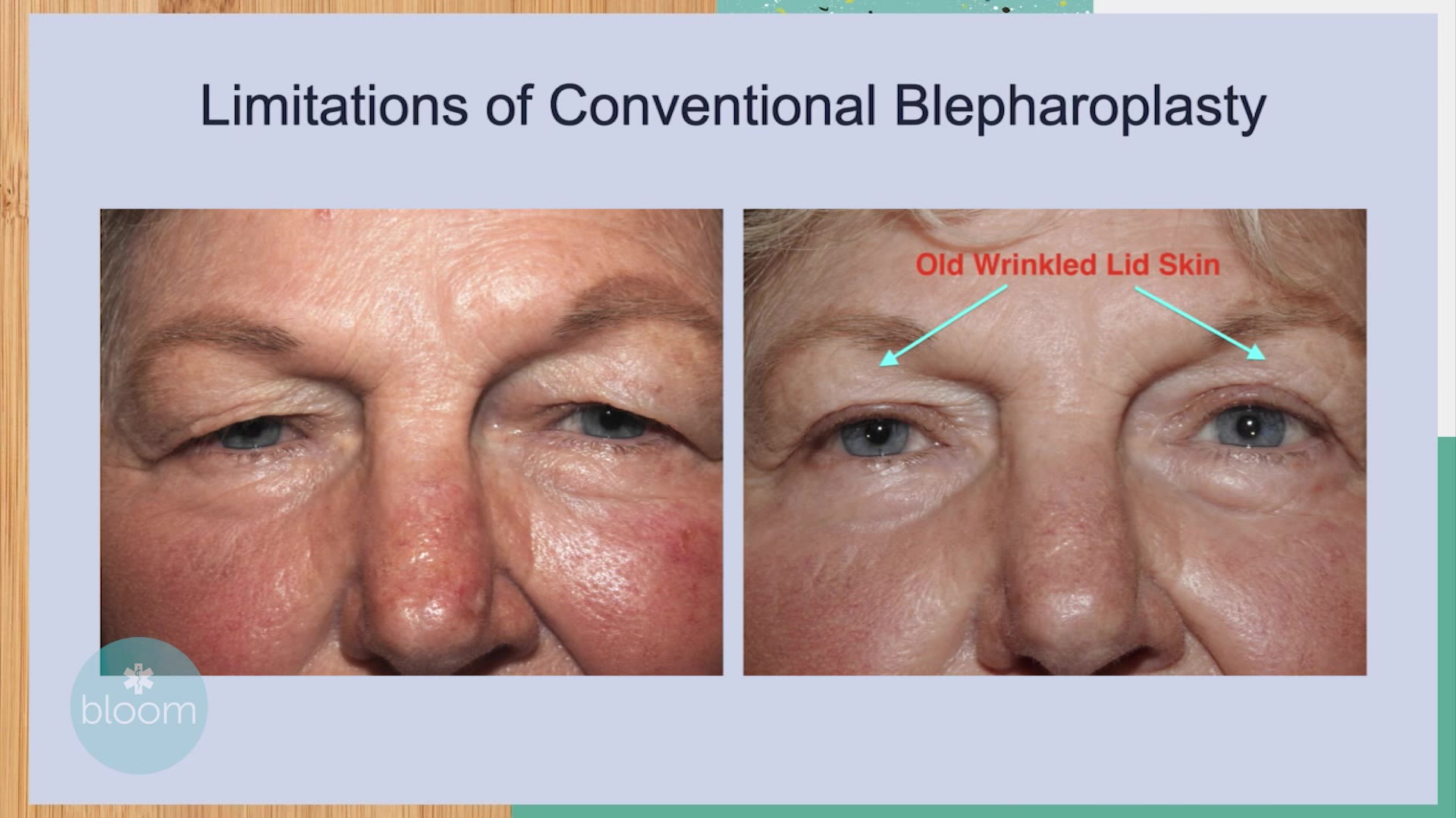 Popular eyelid surgery solution: The Better Blepharoplasty – WFLA