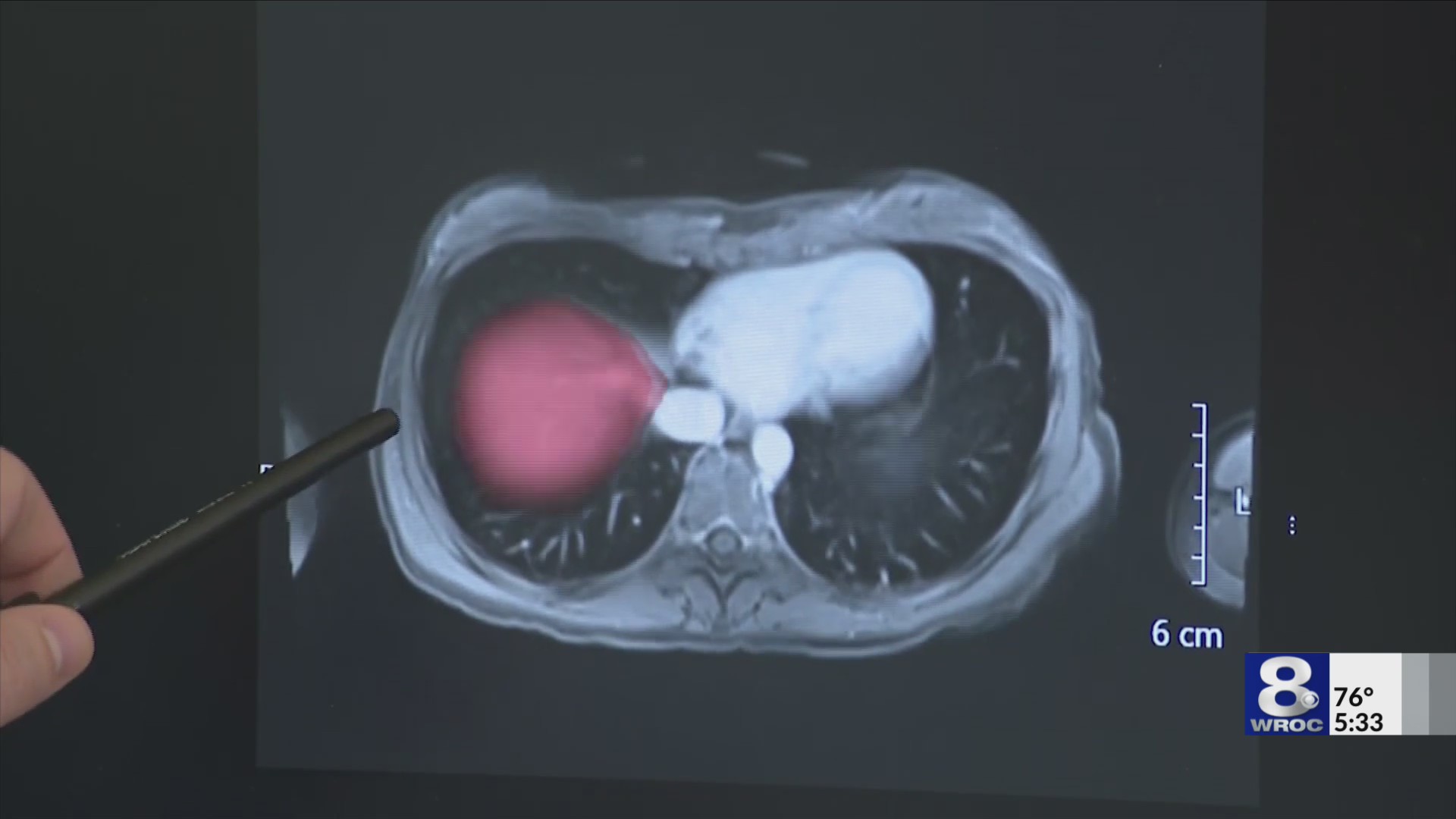 Colorectal cancer survivor credits URMC for rare living donor ...