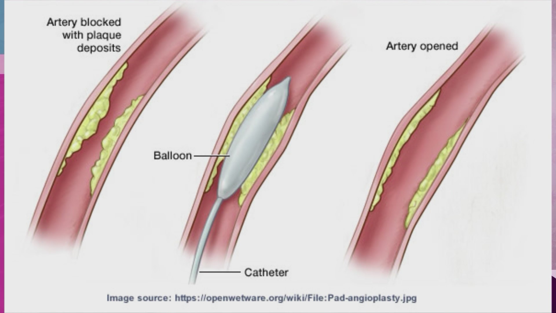 Understanding Peripheral Arterial Disease (PAD) – WREG.com