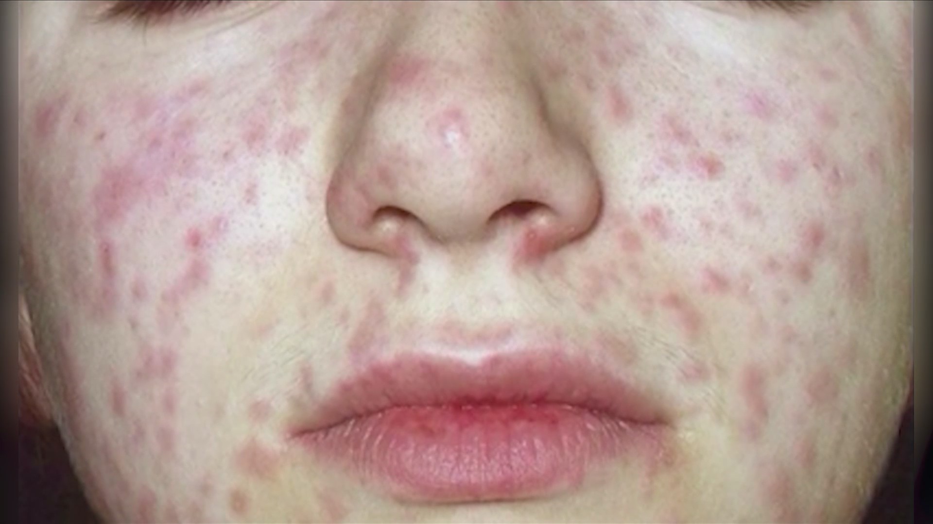 2 new pediatric cases of measles in the Central Valley: Health experts ...