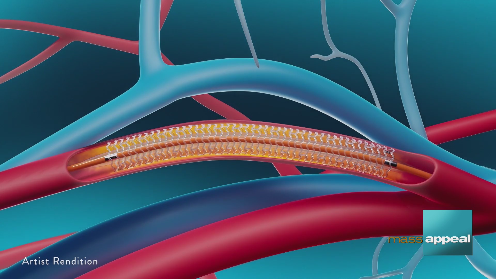 Understanding Peripheral Artery Disease – WWLP