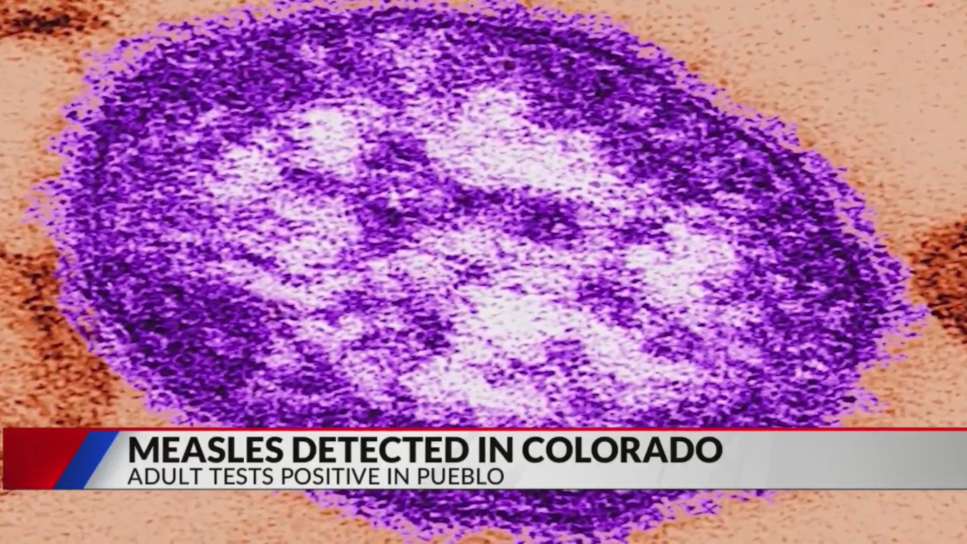 Measles case confirmed in Colorado resident – FOX21 News Colorado
