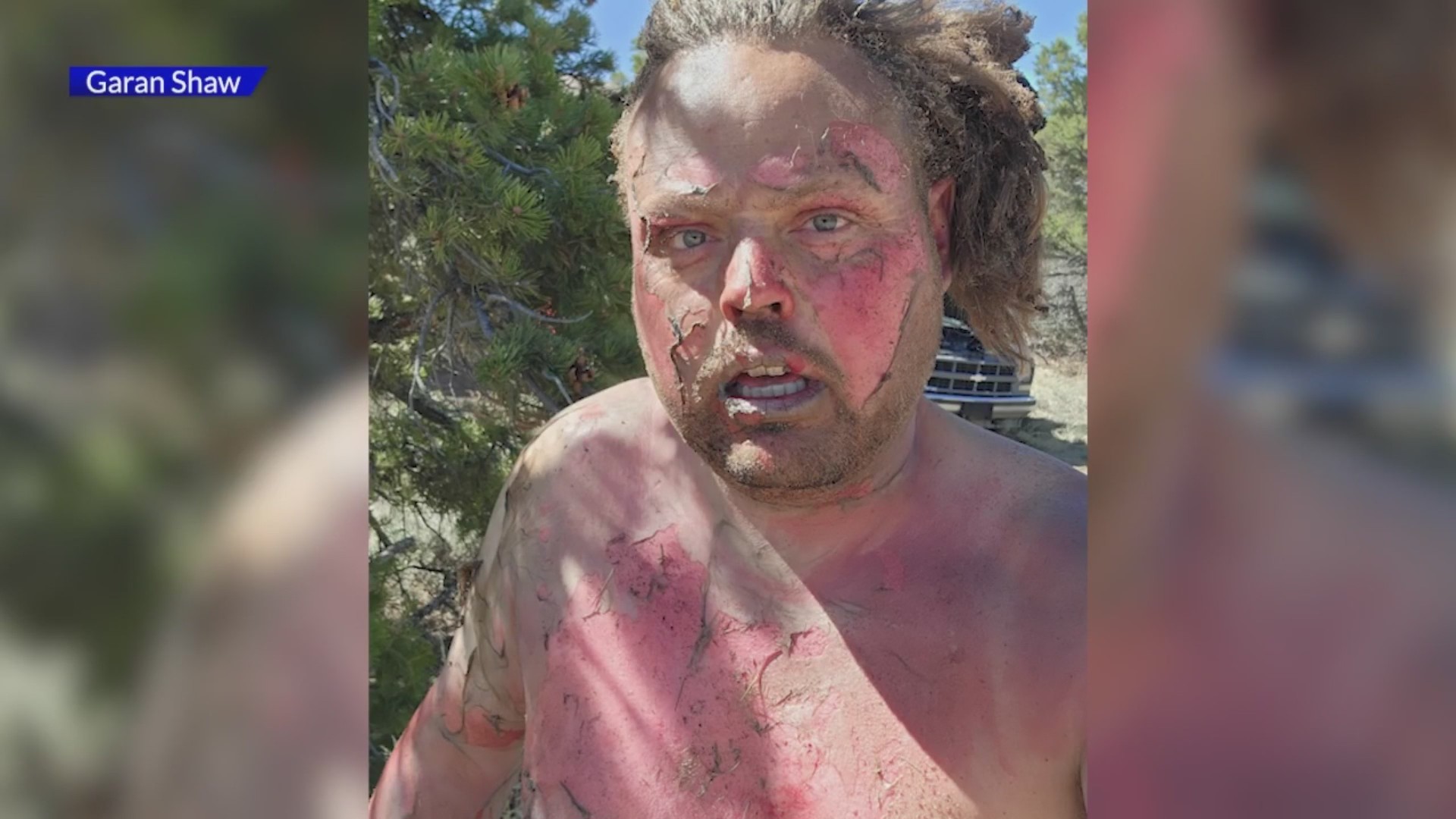 Colorado man shares warning after suffering severe burns in mechanical ...