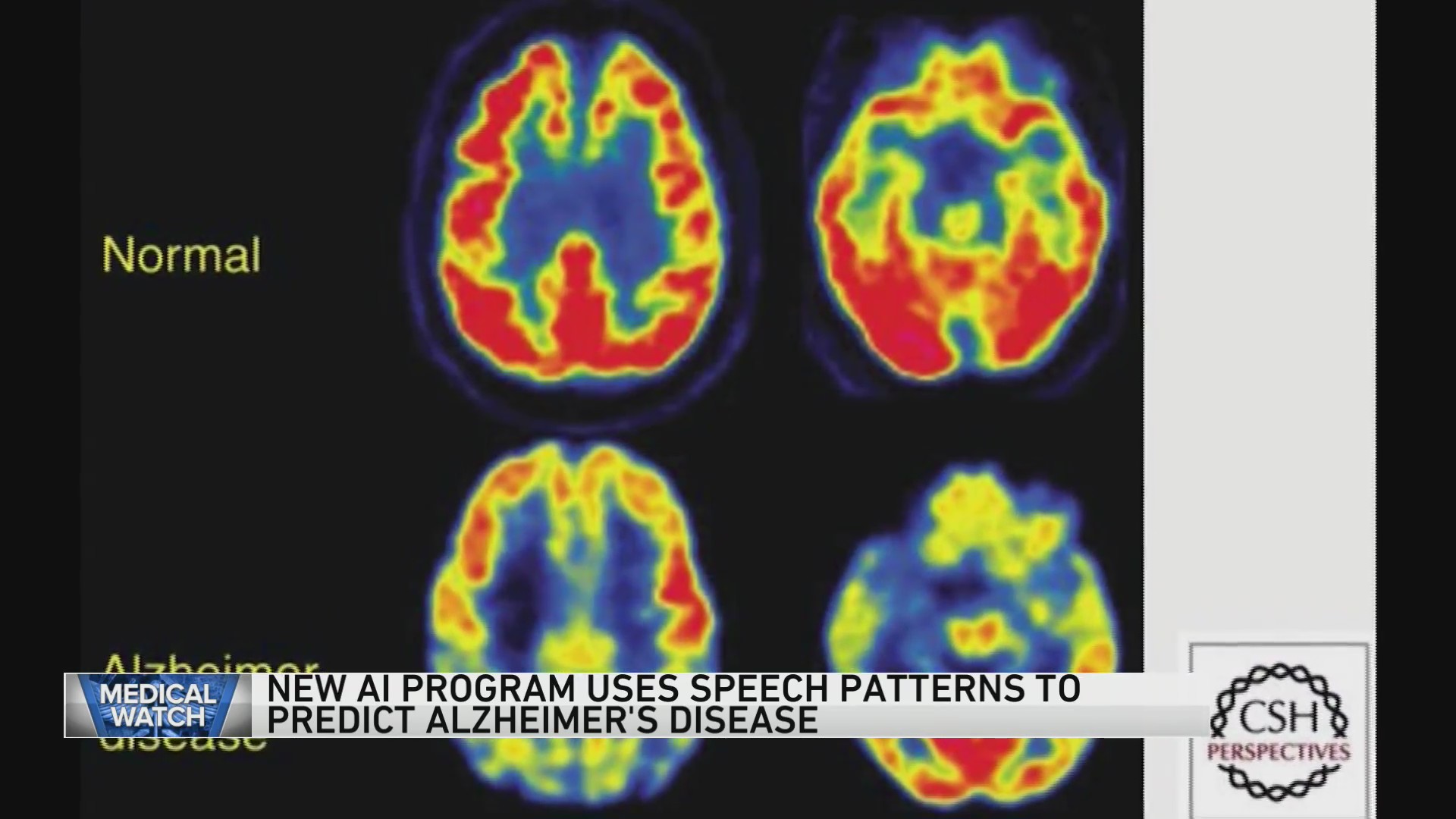 New AI program uses speech patterns to predict Alzheimer’s Disease ...