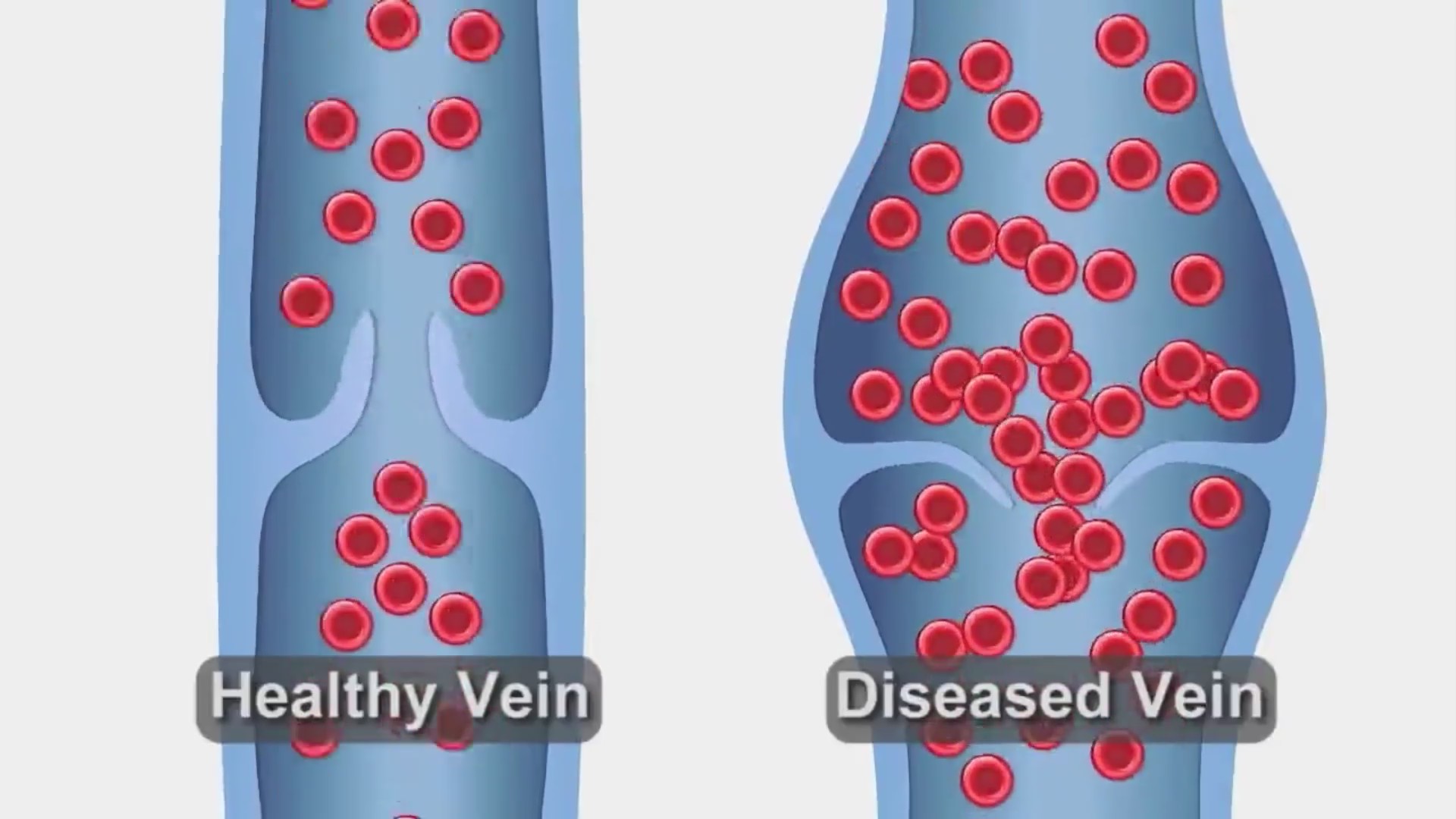 Understanding Vein Disease & Treatment Options – FOX 4 Kansas City WDAF ...