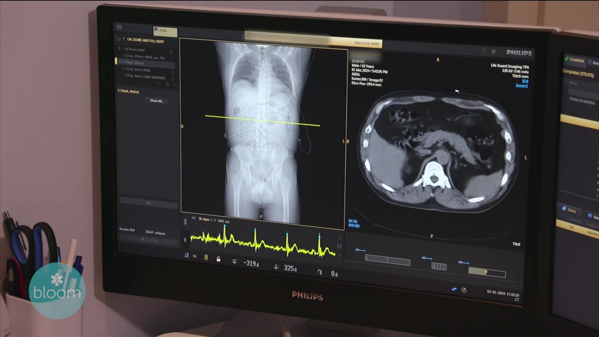Life saving story through early detection – WFLA