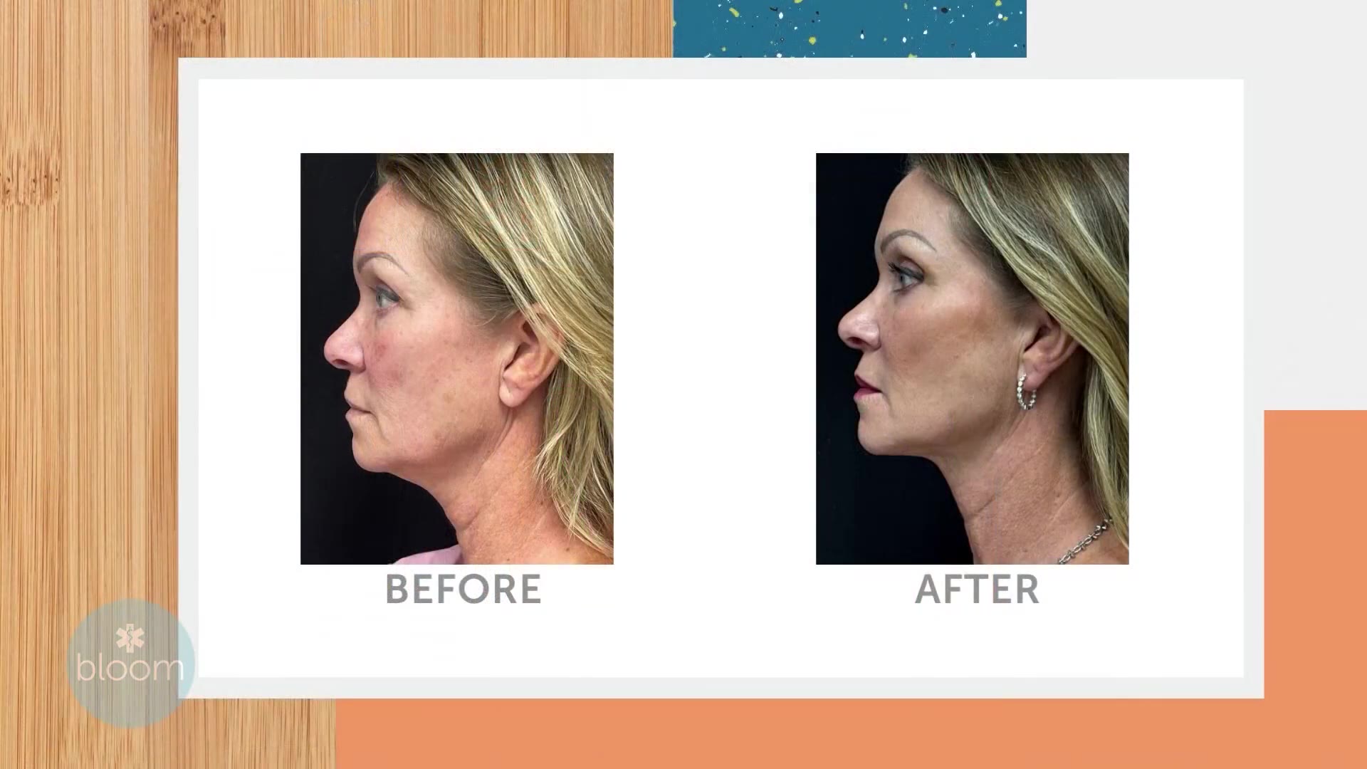 Turn back time and look younger with LazerLift | Bloom – WFLA