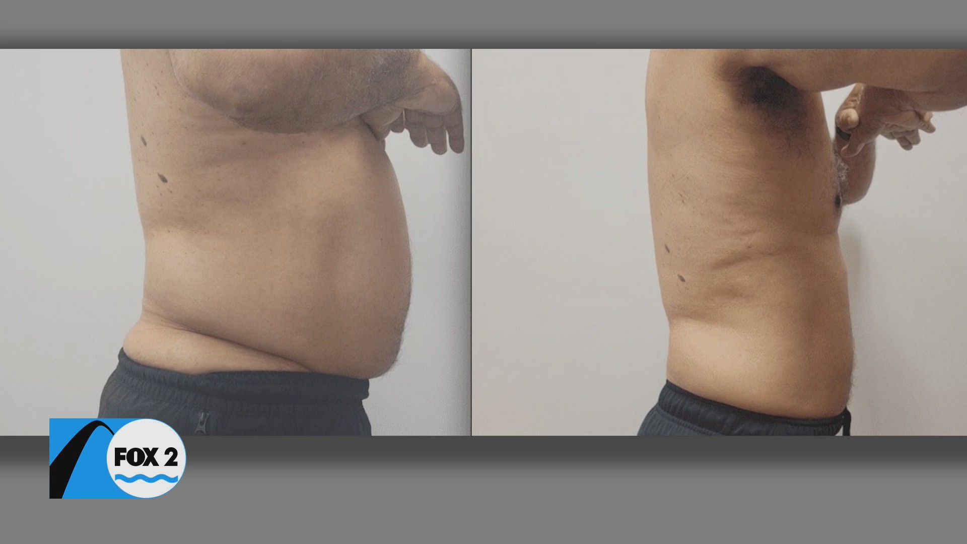 Beautiful Body Med Spa offers non-invasive fat loss treatment – FOX 2