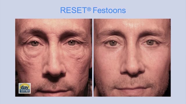 The Festoons fix: A breakthrough for eye bags and under-eye ...