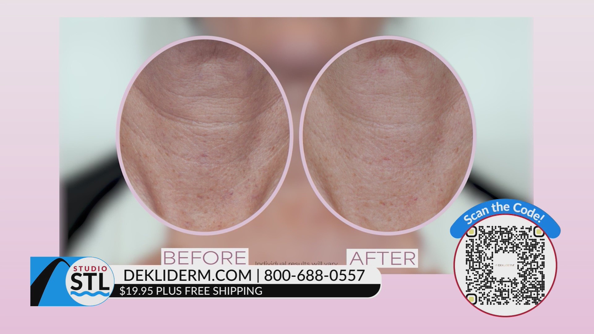 Experience youthful skin with Dekliderm for only $19.95! – FOX 2