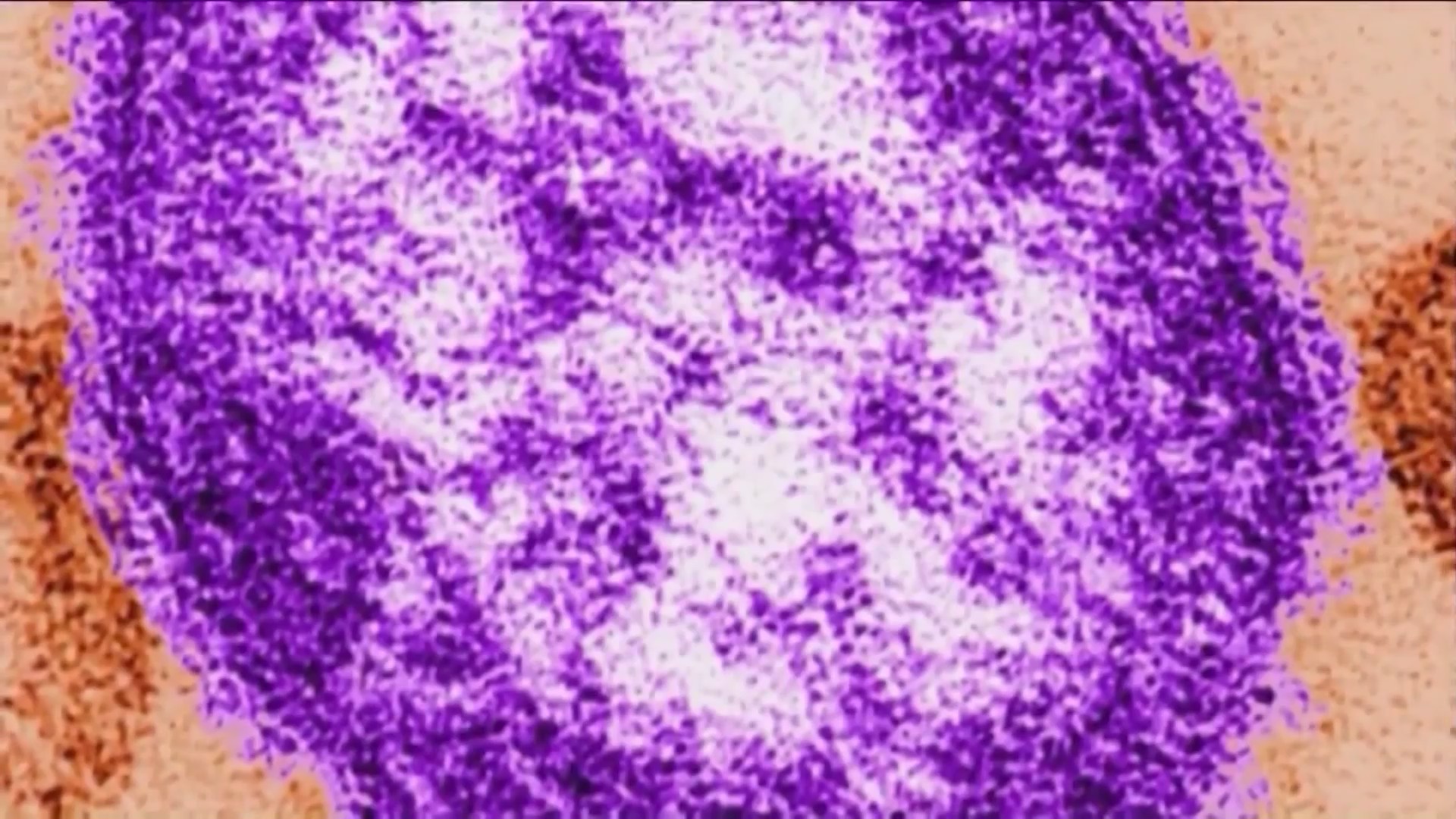 NMDOH: Measles cases rise to 76 in New Mexico; CDC helping monitor ...
