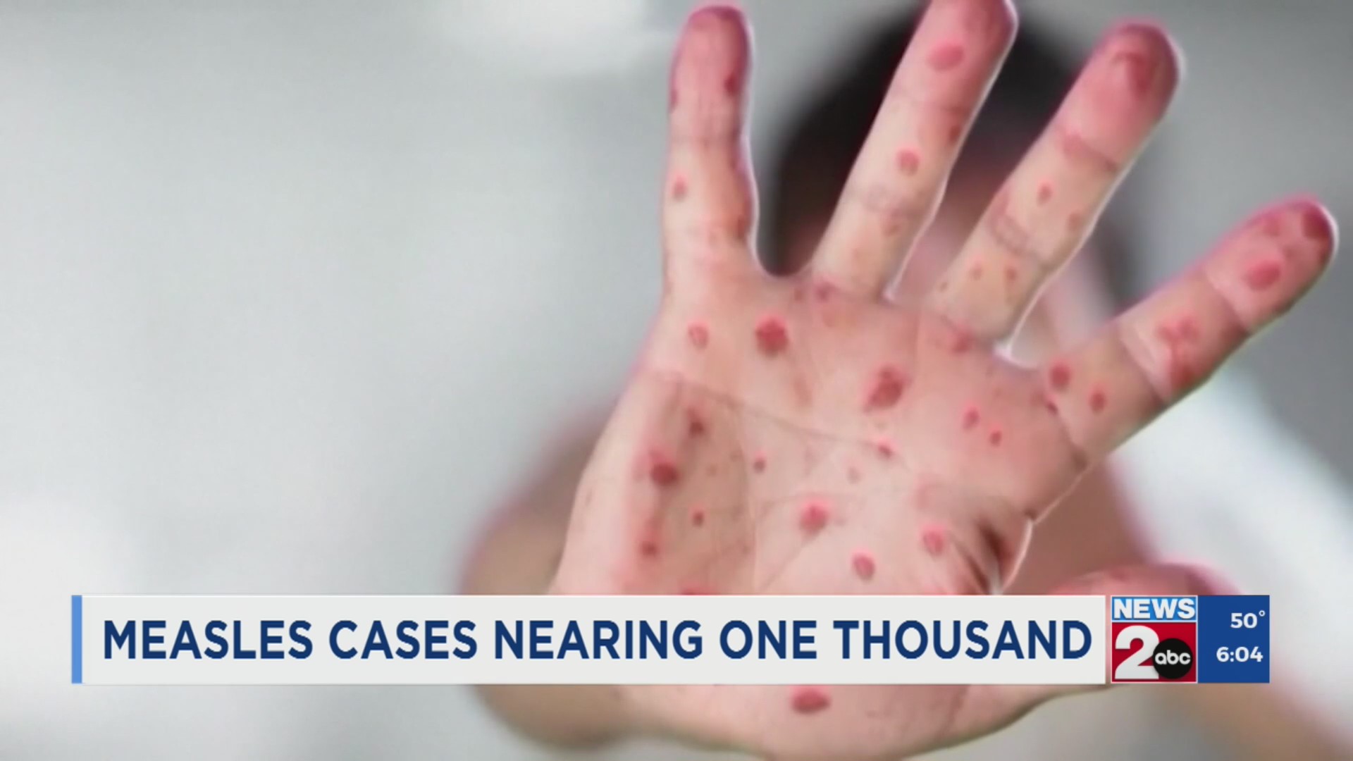 900+ measles cases confirmed in US – WKRN News 2