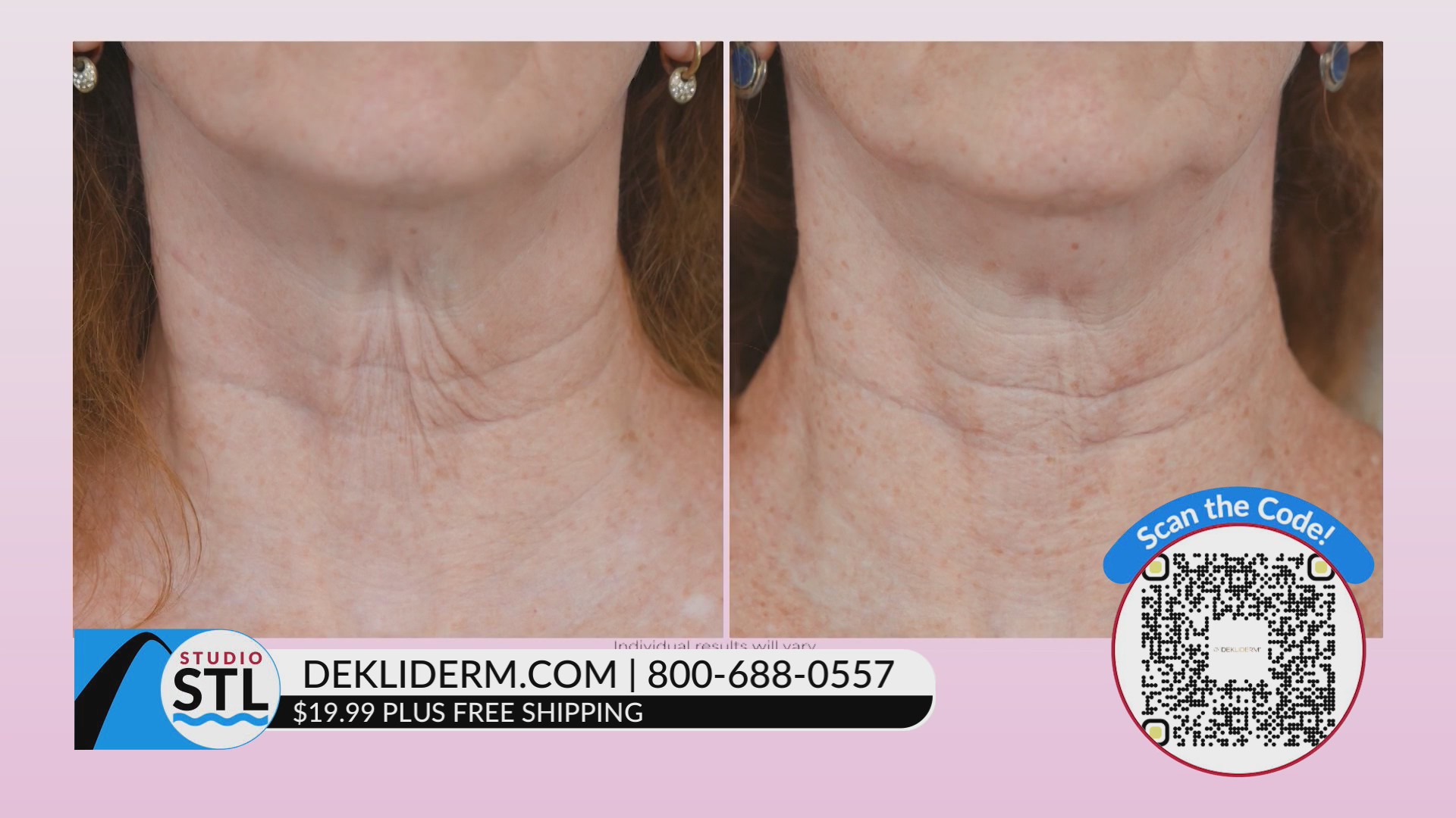 Experience youthful skin with Dekliderm for only $19.95! – FOX 2