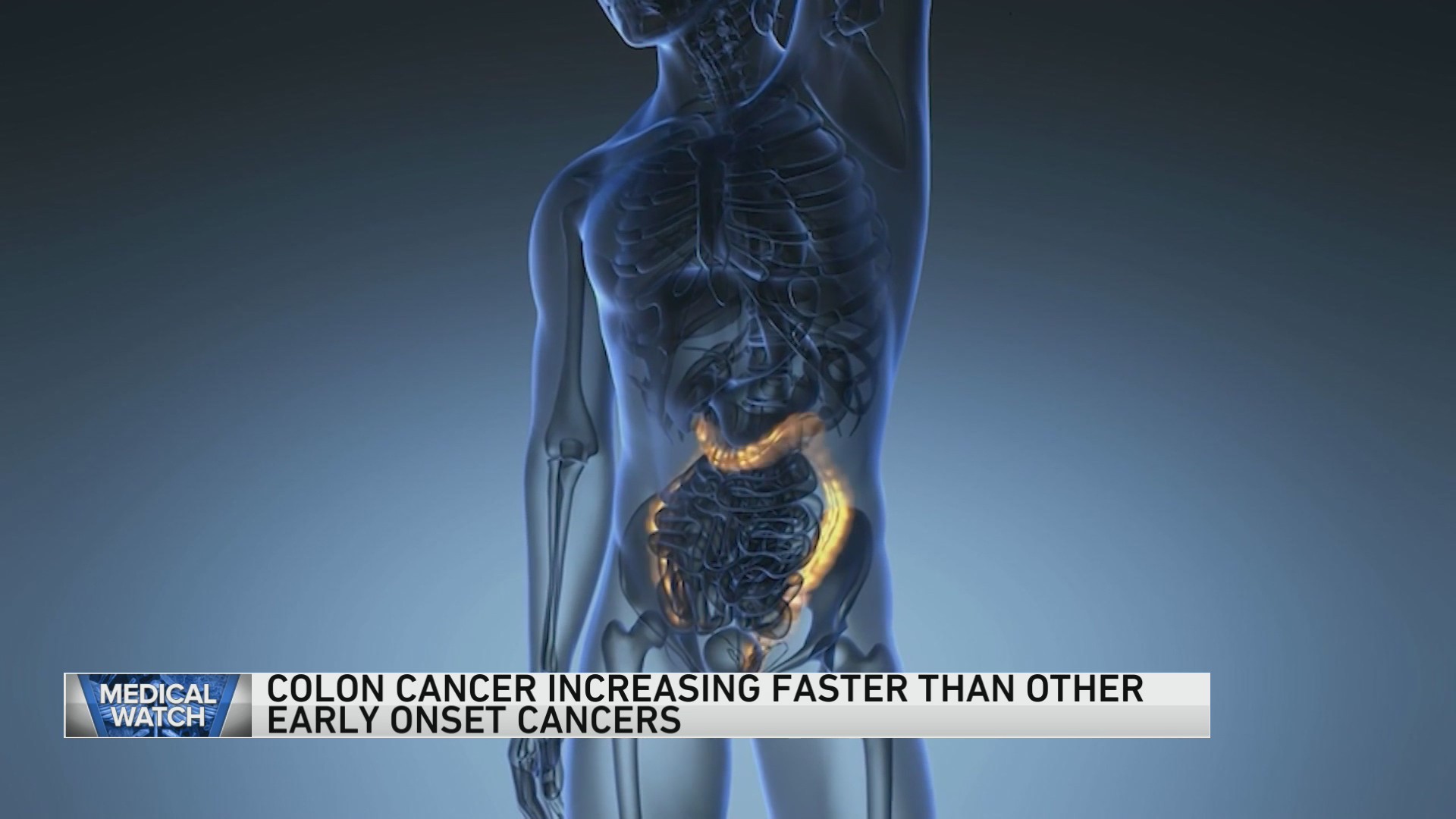 Colon cancer increasing faster than other early onset cancers – WGN-TV