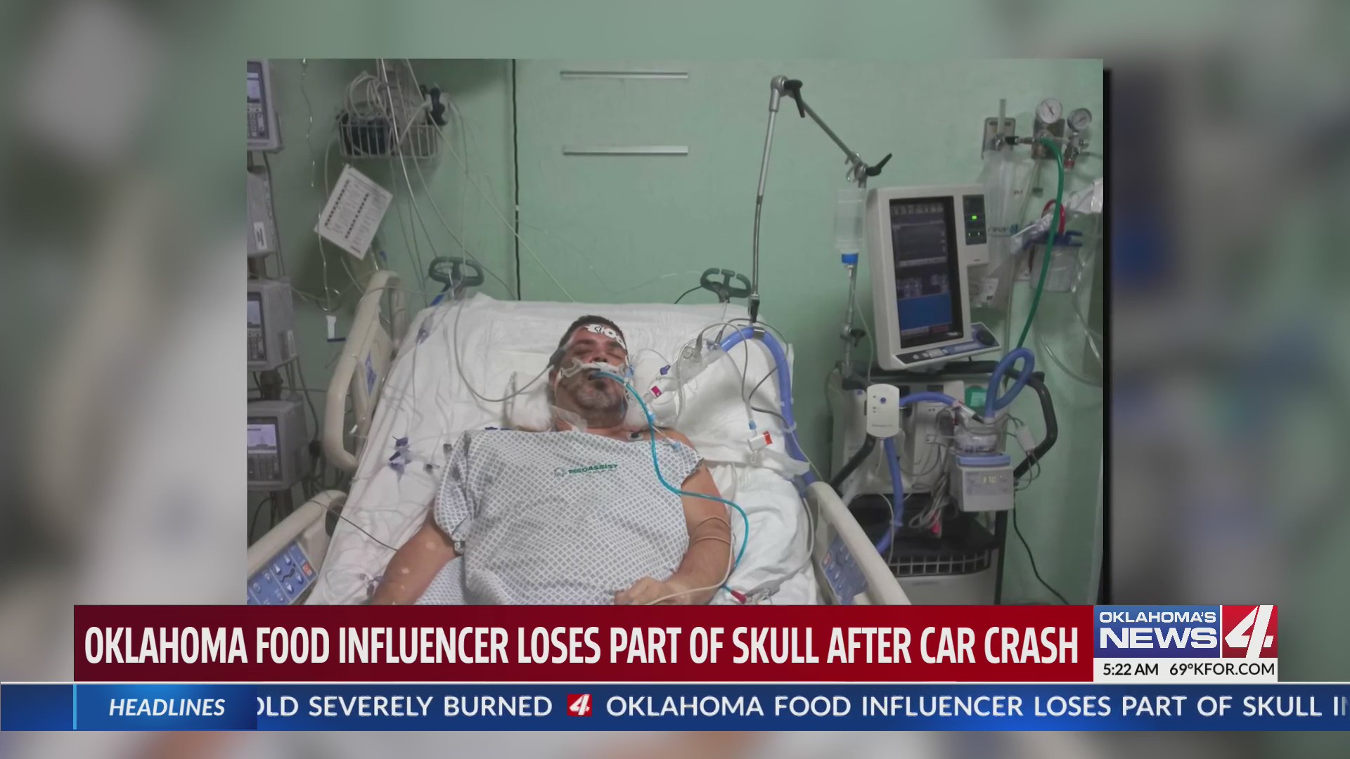 Oklahoma International Food Influencer loses part of skull after crash ...