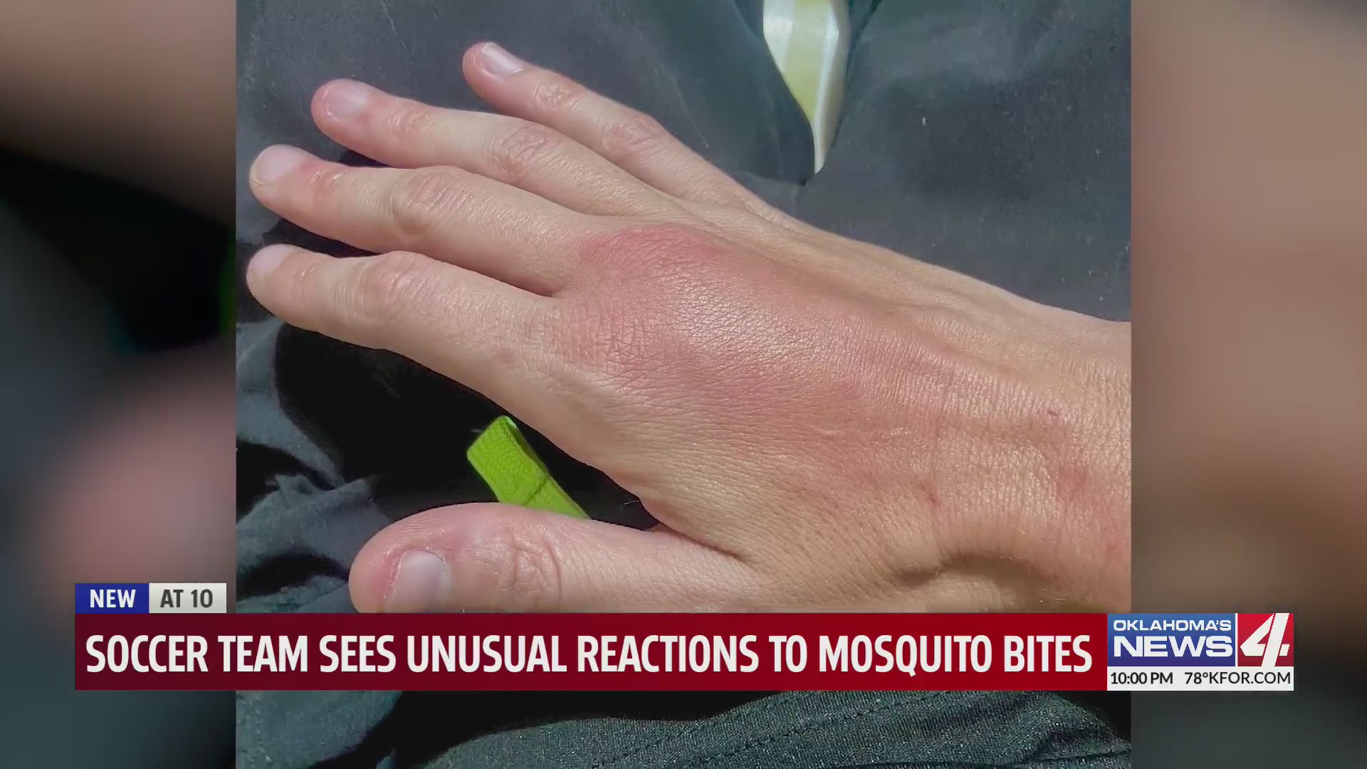 Soccer team sees unusual reactions to mosquito bites – KFOR.com ...