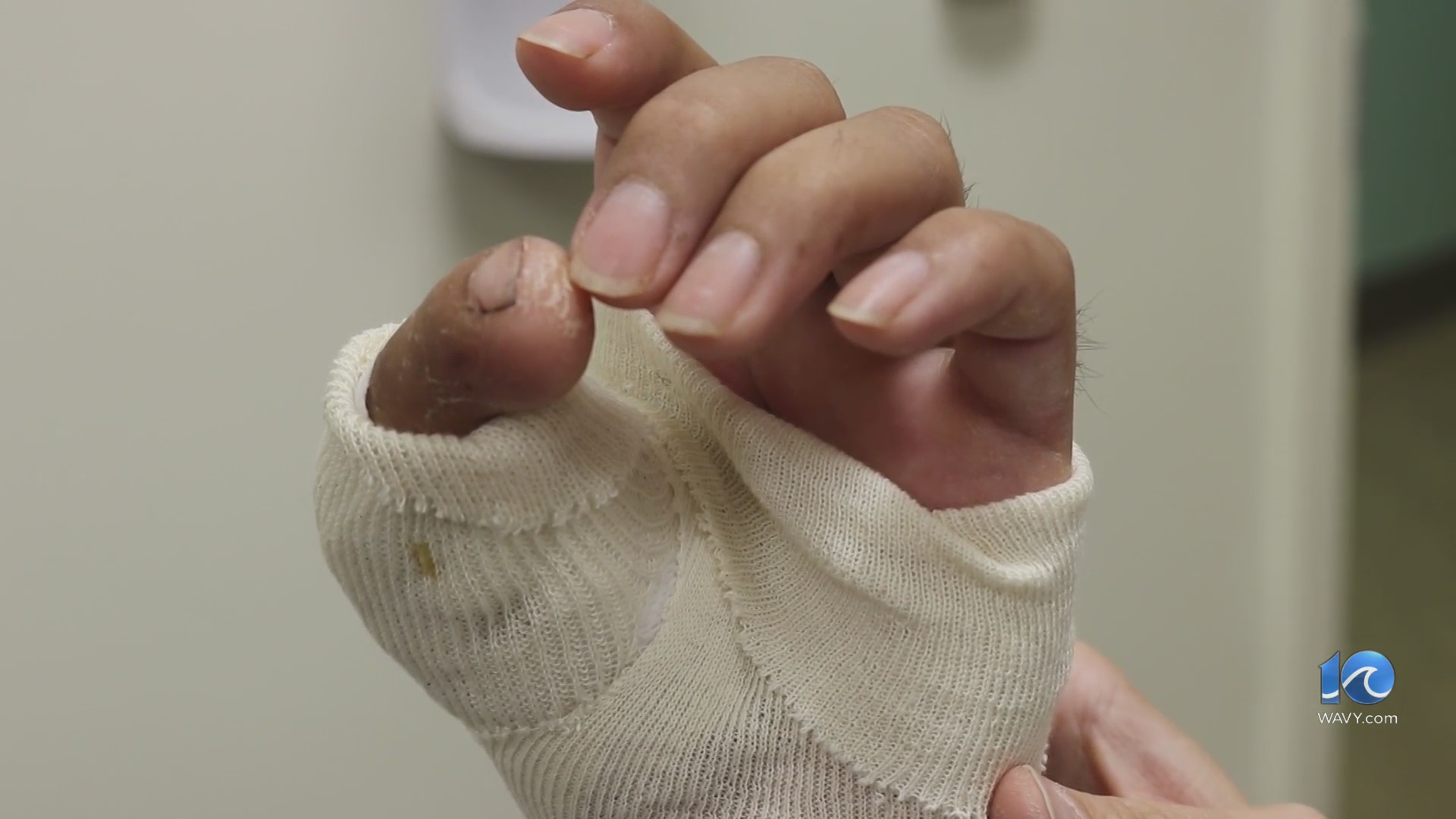 Surgeon replaces patient’s lost thumb with toe – WFLA