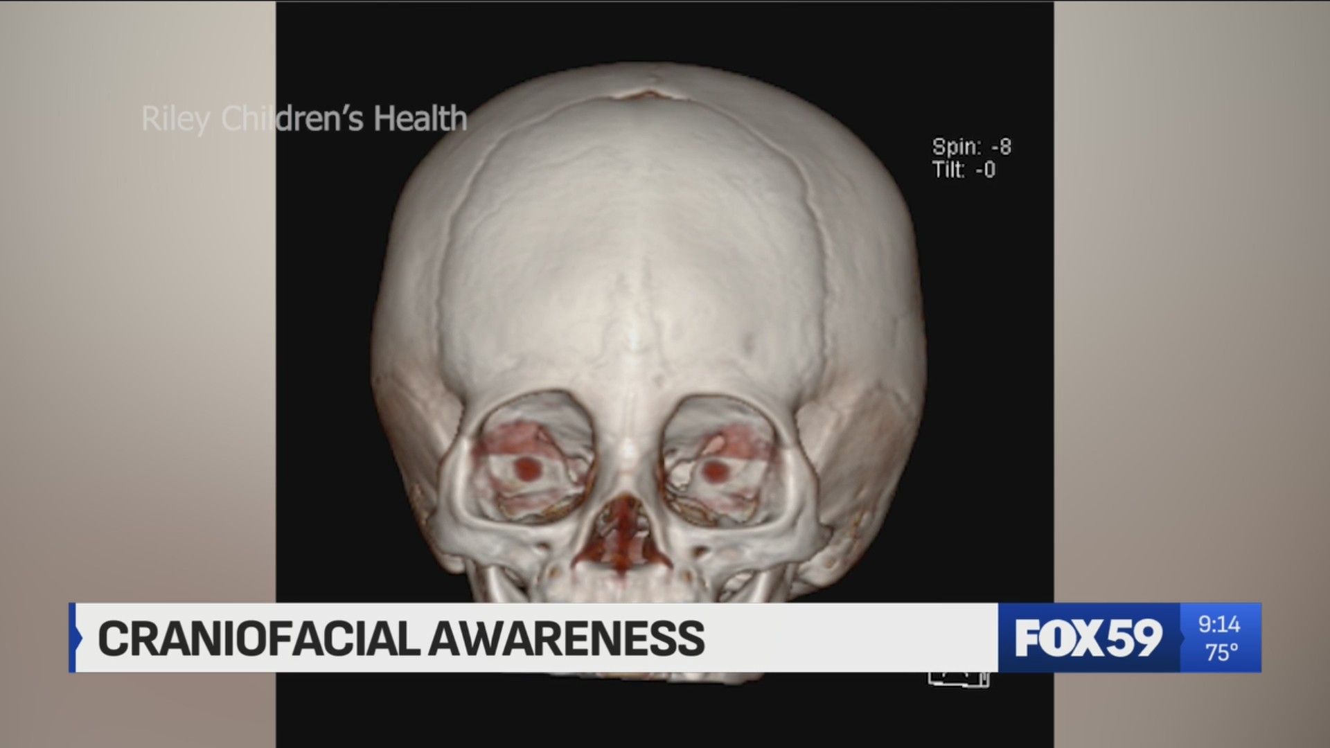 Craniofacial Awareness – Fox 59